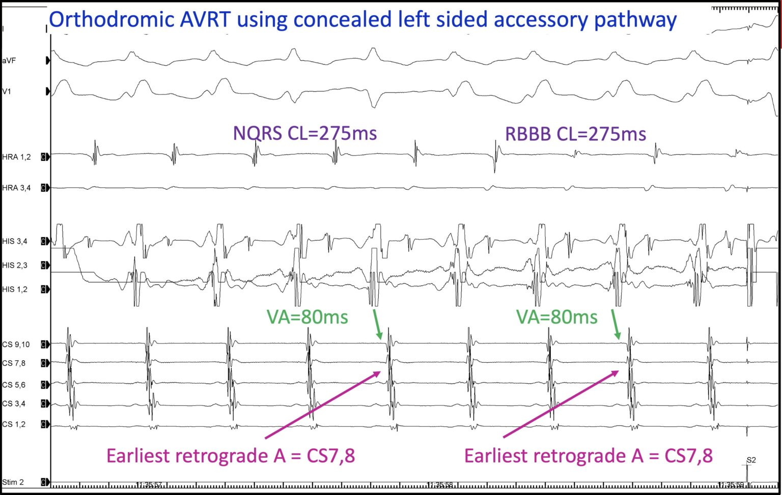 Using 3D Mapping to Locate the Bypass Tract Insertion – CEPIA