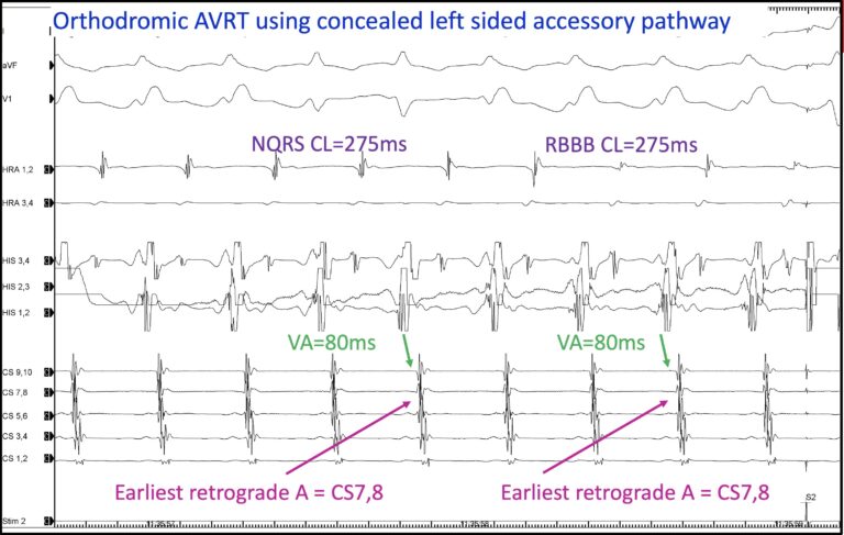 Using 3D Mapping to Locate the Bypass Tract Insertion – CEPIA