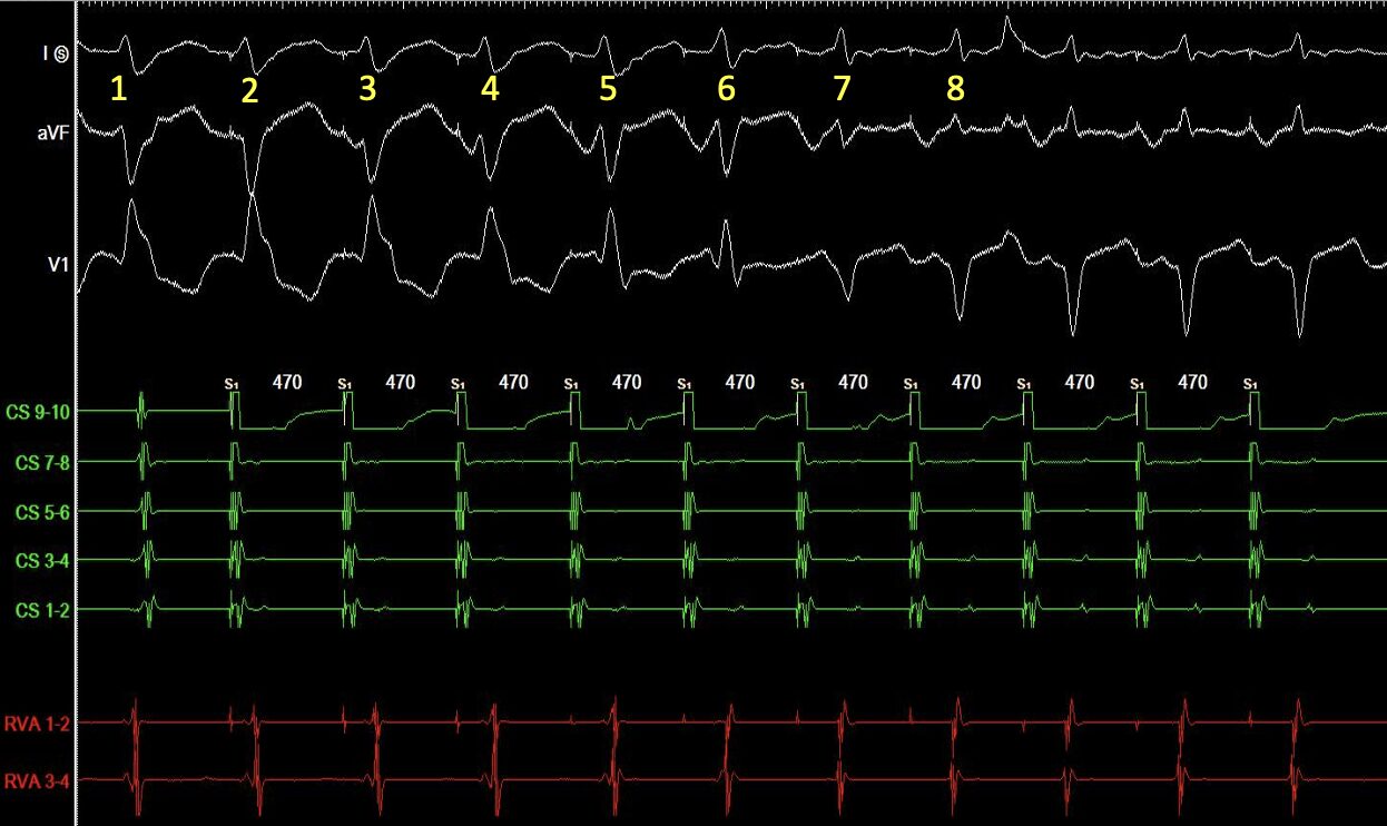 Atrial Overdrive Pacing During a 1:1 Wide Complex Tachycardia – CEPIA