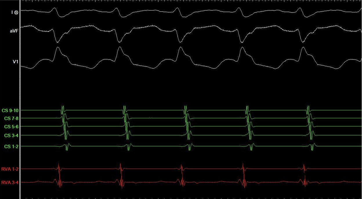 Atrial Overdrive Pacing During a 1:1 Wide Complex Tachycardia – CEPIA